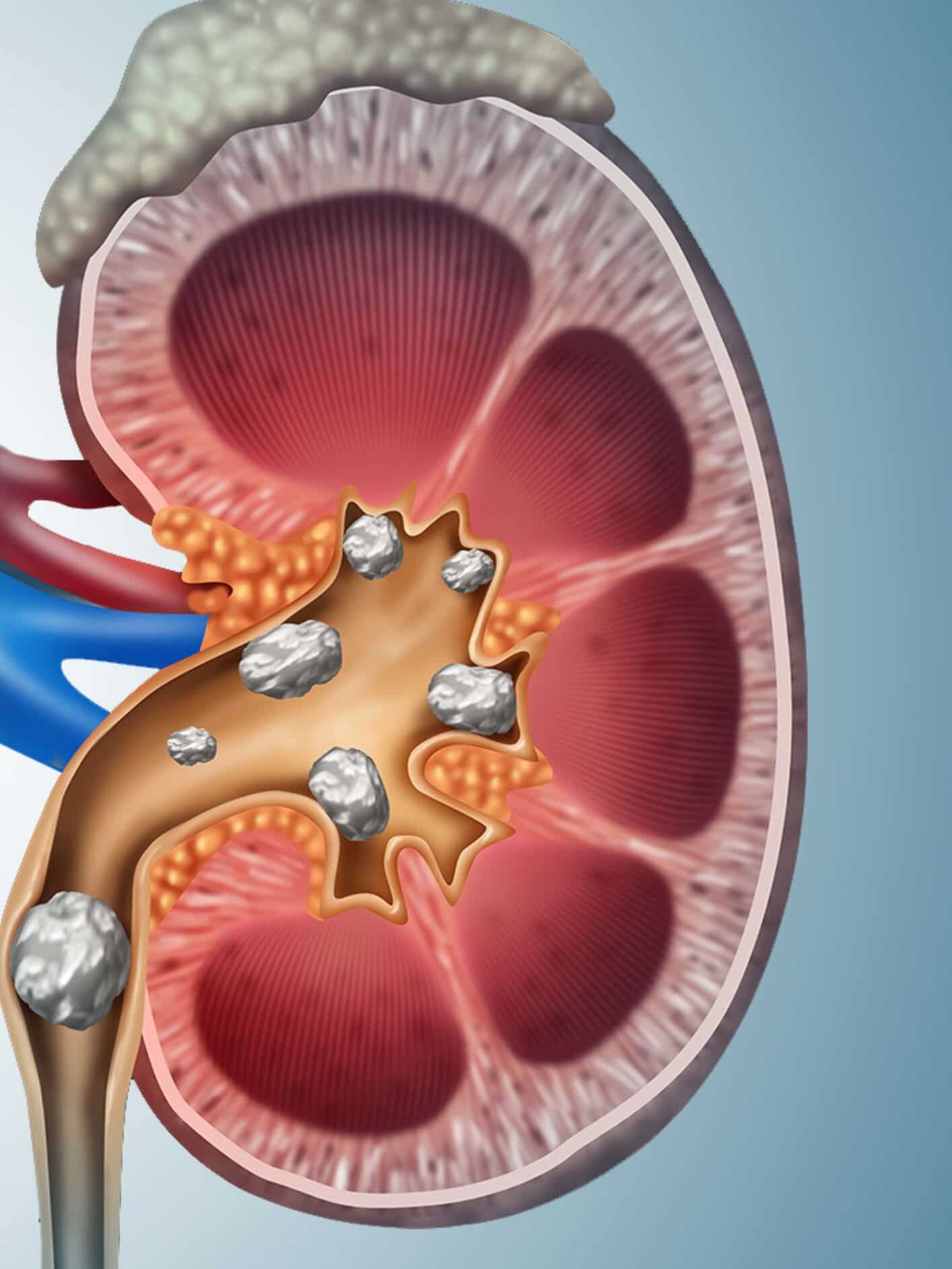 6 ways to prevent kidney stone formation