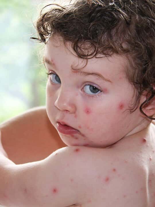 Signs and symptoms of chicken pox