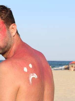 Sunburn vs Sun Poisoning: What's the difference?