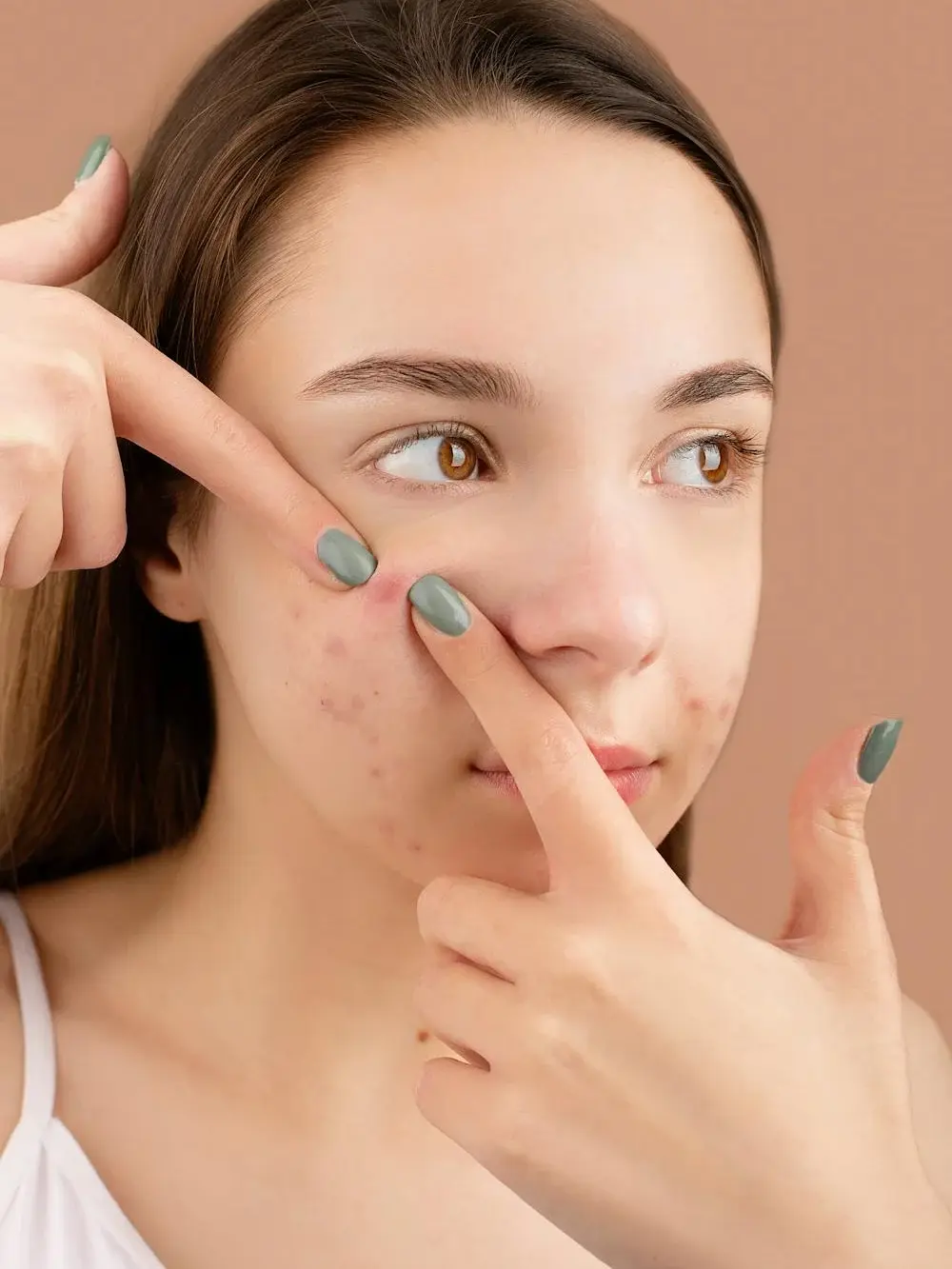 Does dairy intake really cause acne? Here's the truth