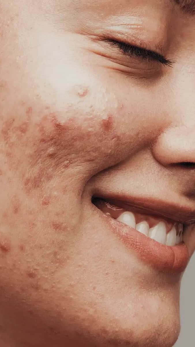 7 Tips to get rid of pimple