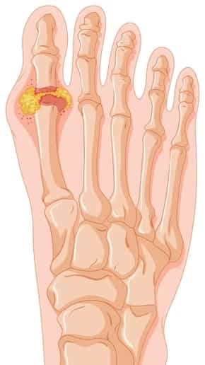 Uric acid: 5 Gout symptoms in fingers