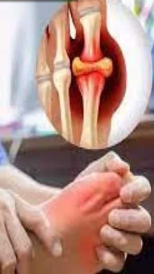 Gout: Home remedies to lower uric acid levels