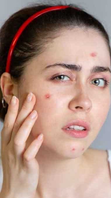 8 Benefits of desi ghee to cure pimples