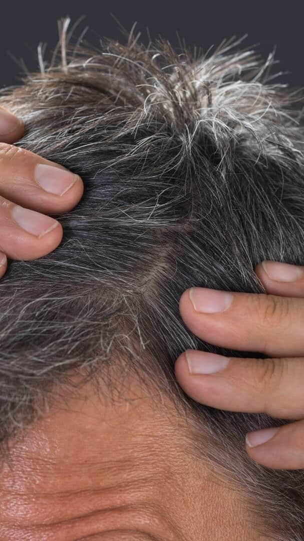 8 superfoods to prevent premature greying of hair