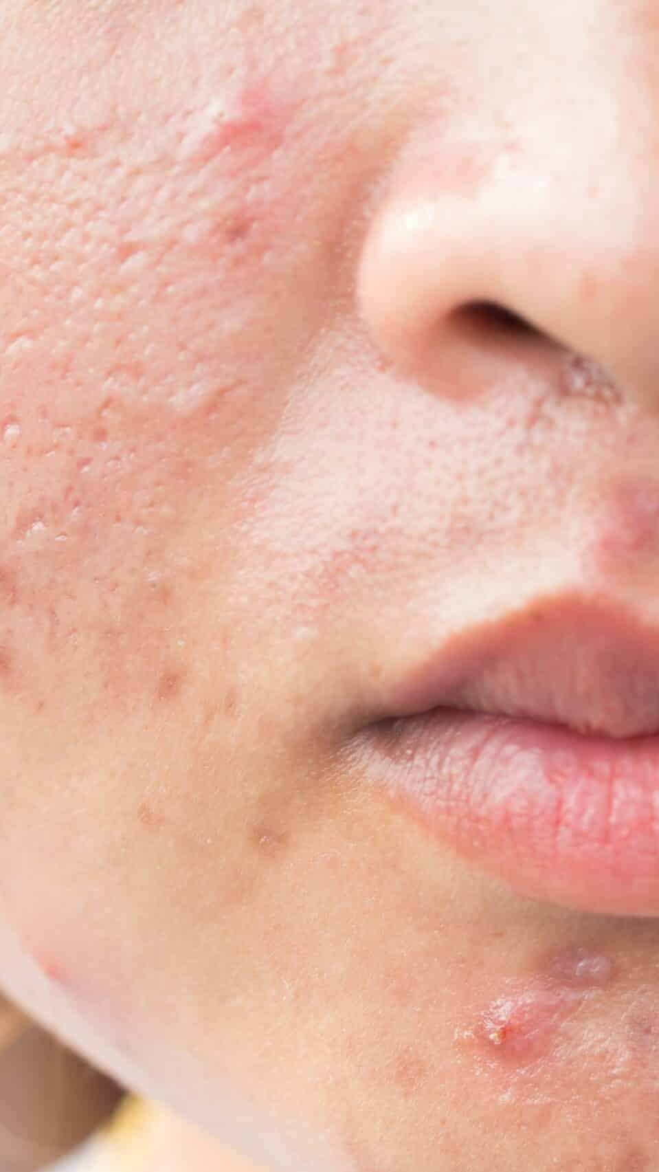 8 home remedies to get rid of pimples