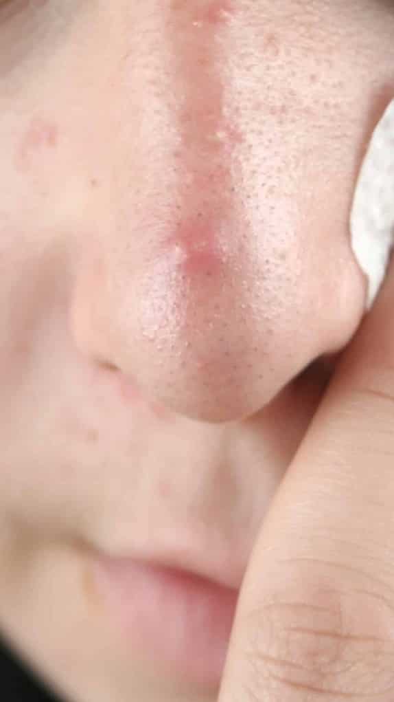 8 home remedies to treat whiteheads