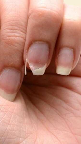 इस विटामिन की कमी से टूटने लगते हैं नाखून